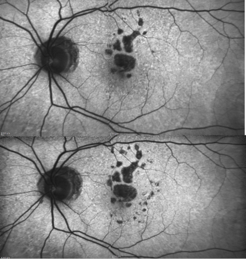 Fundus autofluorescence in age-related macular degeneration | www.amdbook.org